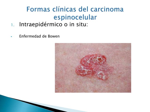 Carcinoma basocelular y espinocelular | PPTX