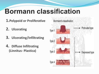 Carcinoma stomach | PPT