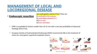 CARCINOMA STOMACH, Investigations and adjuvant treatment | PPTX
