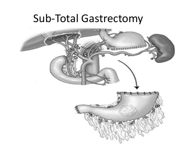 Total Gastrectomy Anatomy