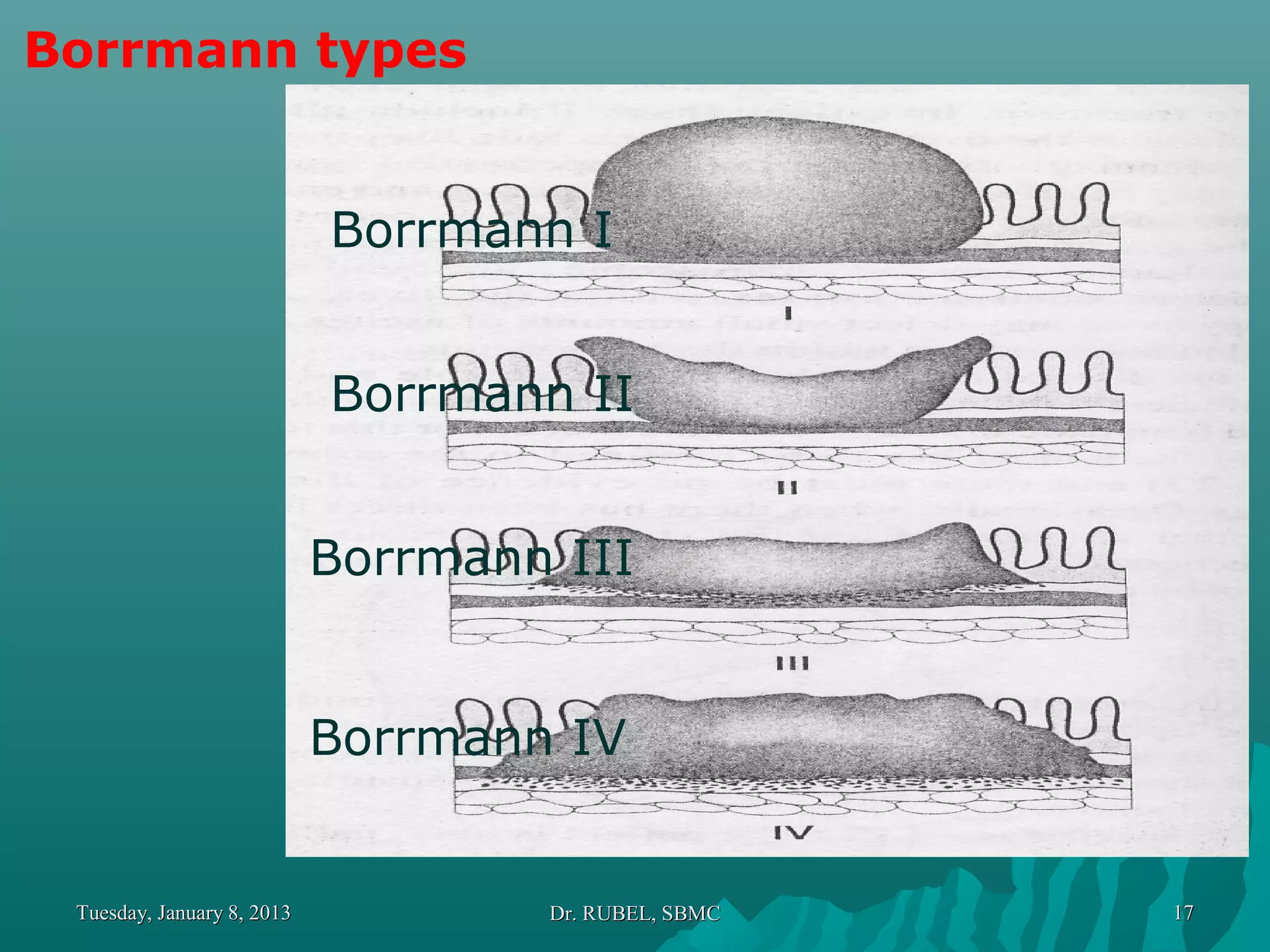 Carcinoma stomach sb-rubel | PPT