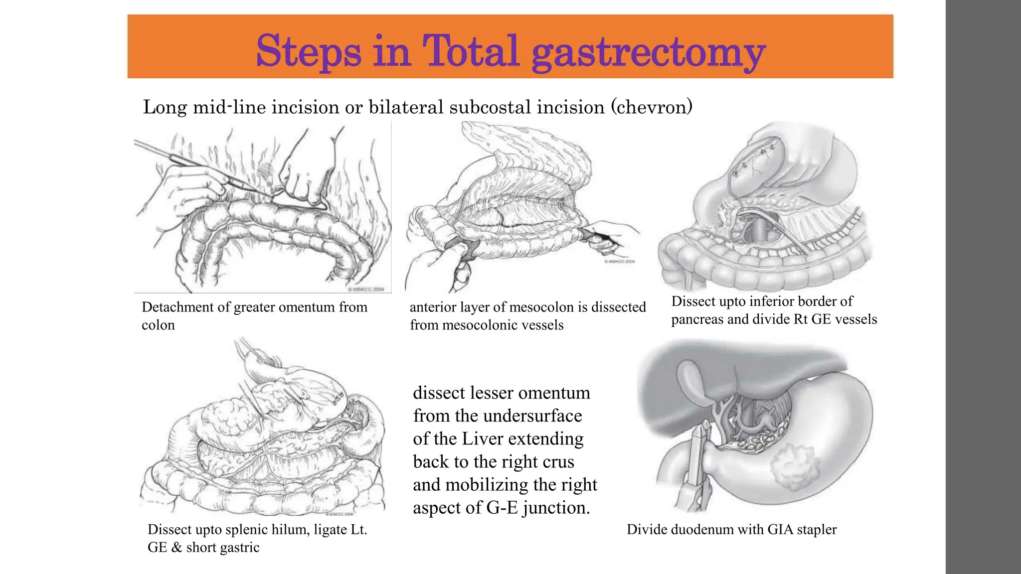 CARCINOMA STOMACH- MANAGEMENT PRINCIPLES | PPTX