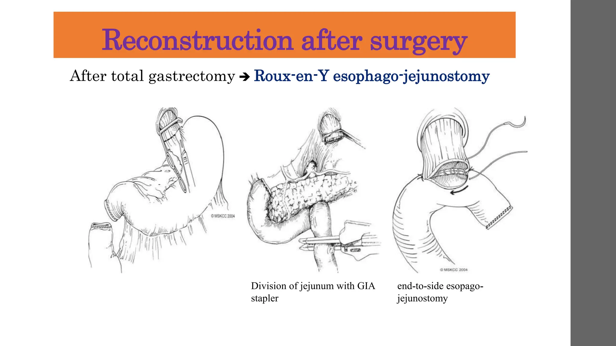 CARCINOMA STOMACH- MANAGEMENT PRINCIPLES | PPTX