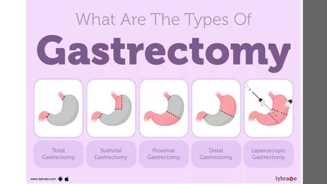CARCINOMA STOMACH- MANAGEMENT PRINCIPLES | PPTX | Cancer | Diseases and ...