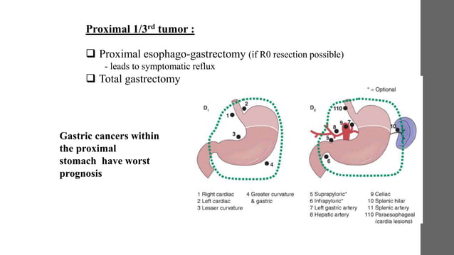 CARCINOMA STOMACH- MANAGEMENT PRINCIPLES | PPTX | Cancer | Diseases and ...