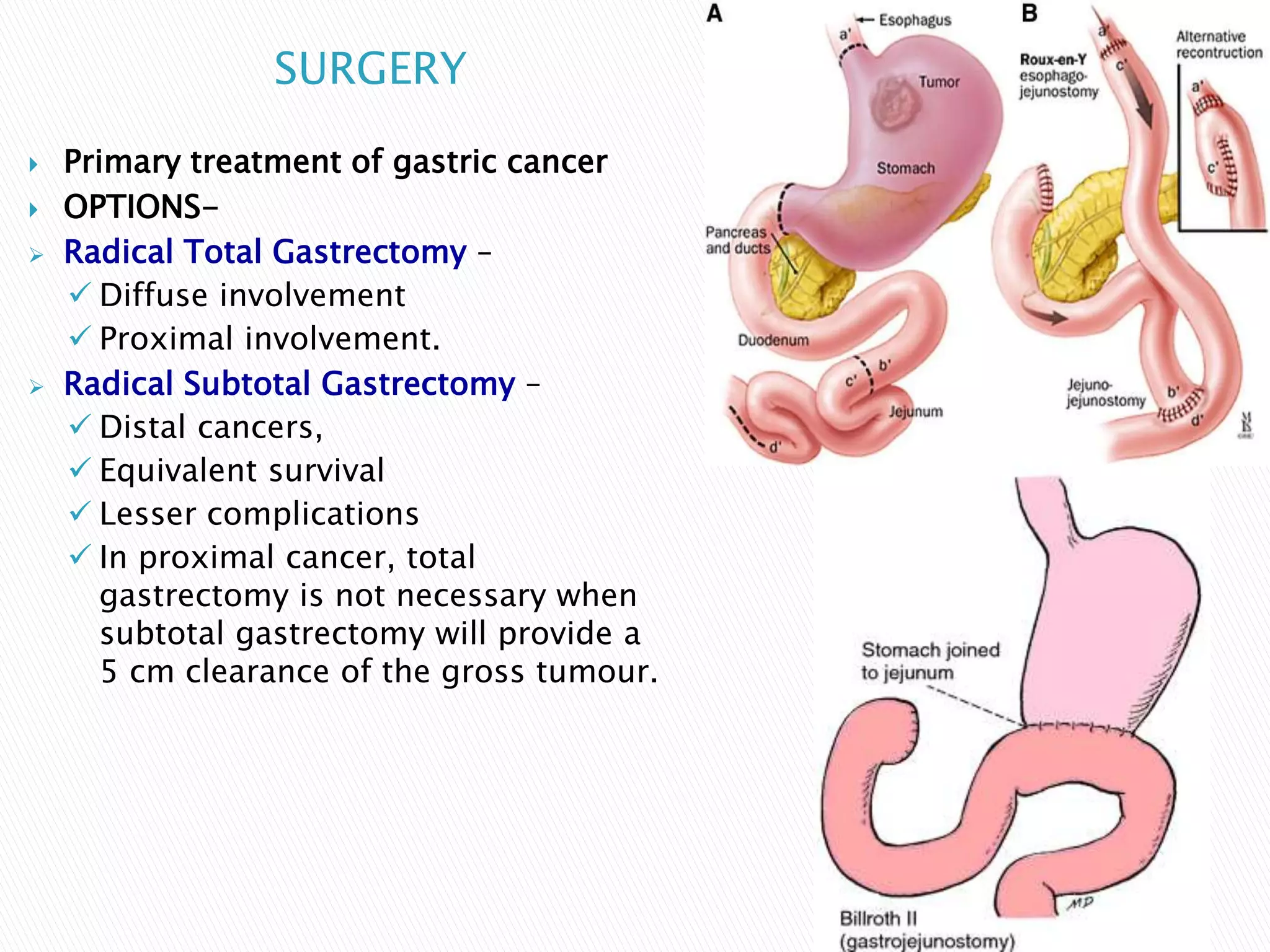 Carcinoma stomach presentation | PPTX
