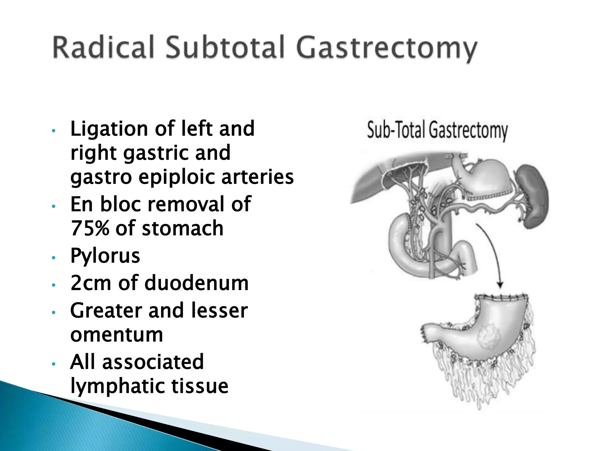 Carcinoma stomach presentation | PPTX