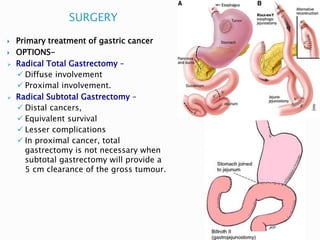 carcinoma stomach | PDF