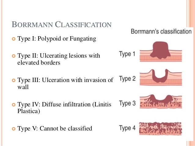 Carcinoma stomach seminar