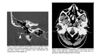 Carcinoma temporal bone | PPTX