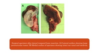 Carcinoma temporal bone | PPTX
