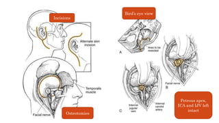 Carcinoma temporal bone | PPTX
