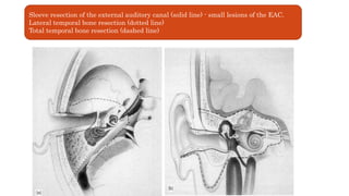 Carcinoma temporal bone | PPTX