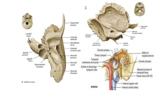 Carcinoma temporal bone | PPTX