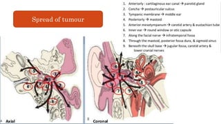 Carcinoma temporal bone | PPTX