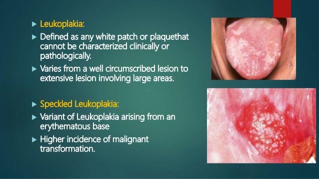 Carcinoma tongue ug class