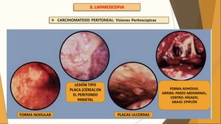 carcinomatosis-peritoneal-pptx