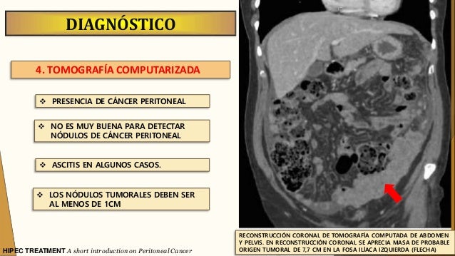 Carcinomatosis peritoneal
