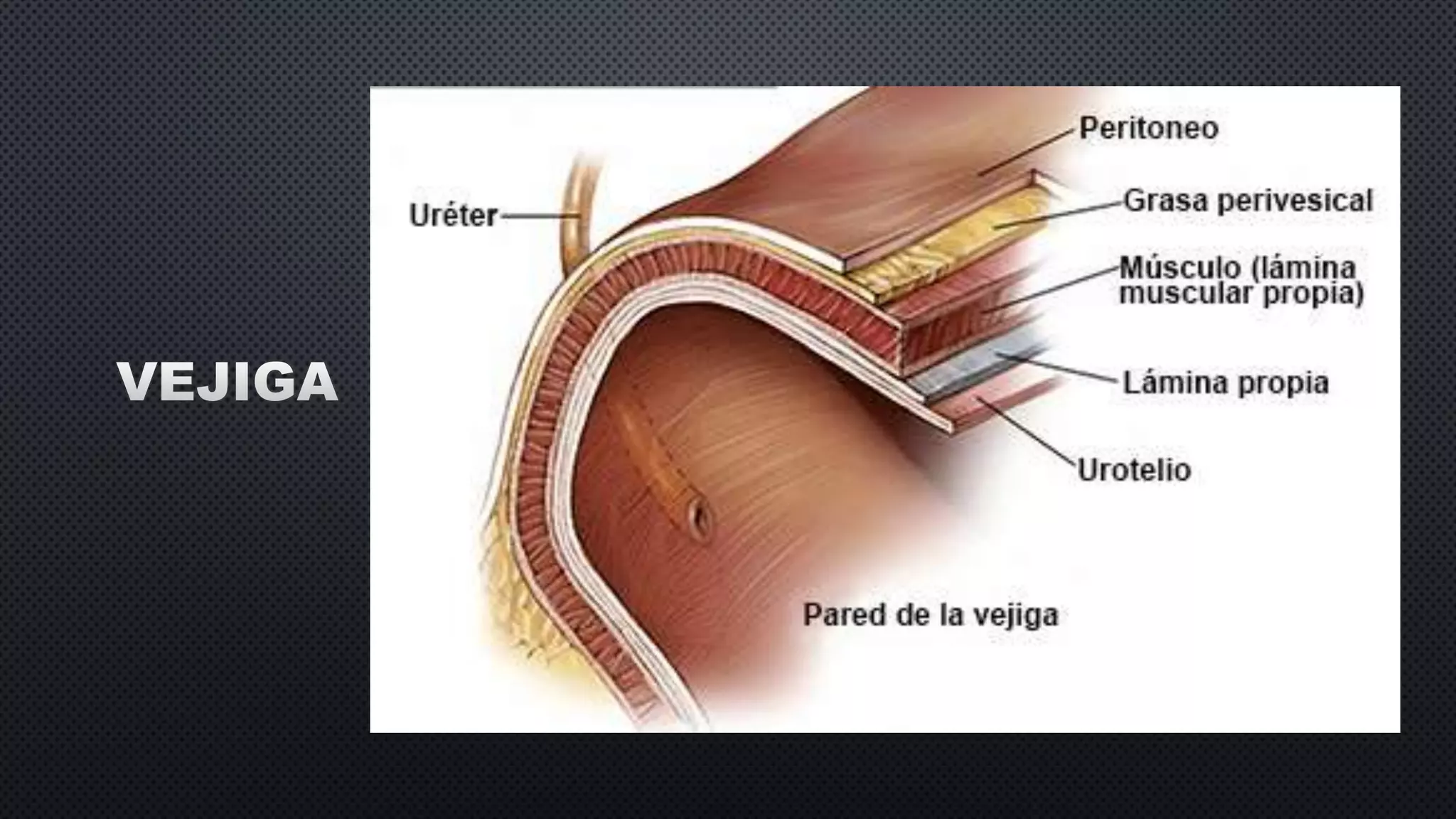 CARCINOMA VEJIGA.pptx