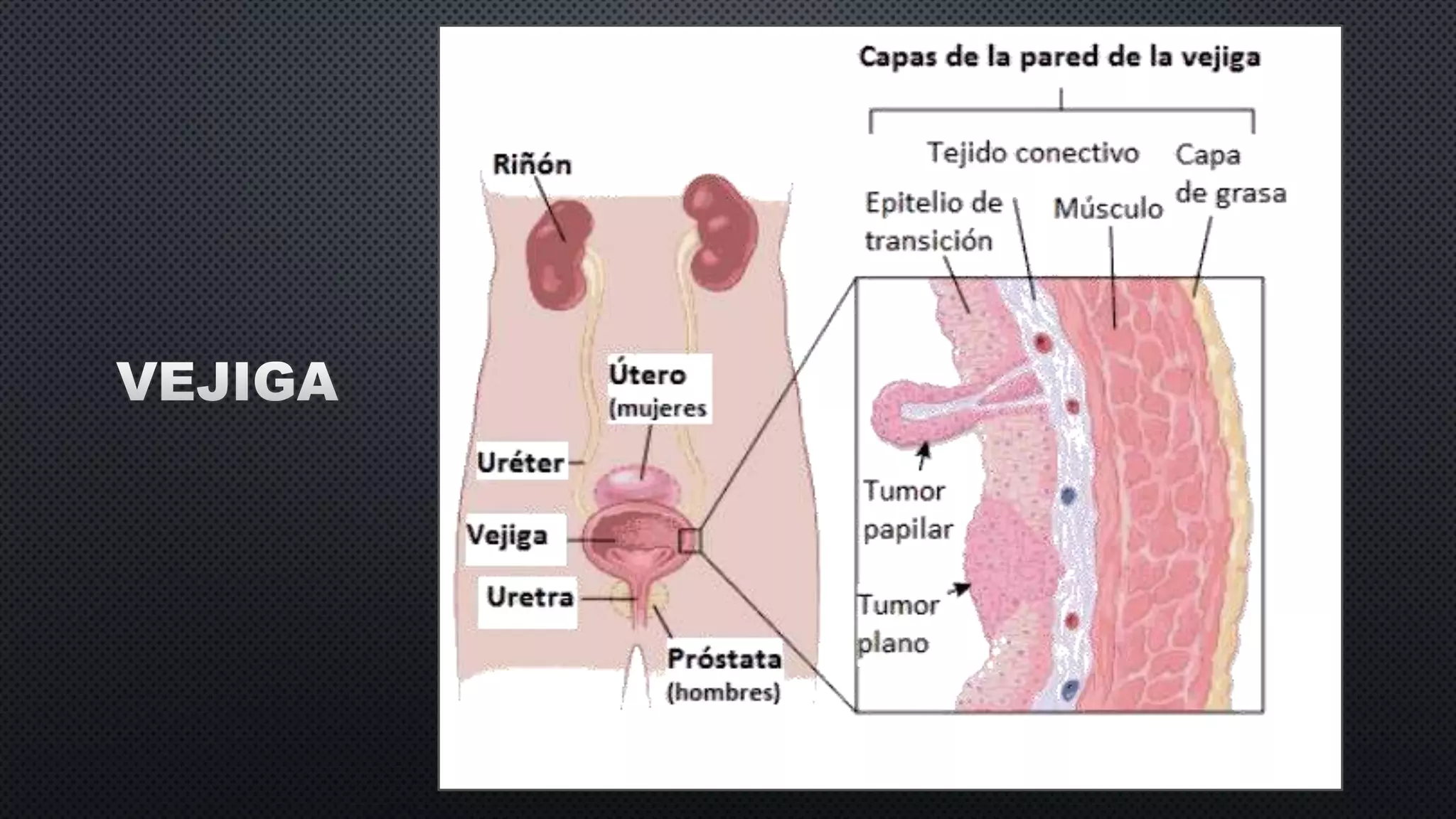 CARCINOMA VEJIGA.pptx