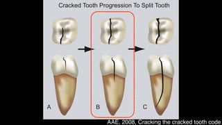 Carcked teeth | PPT