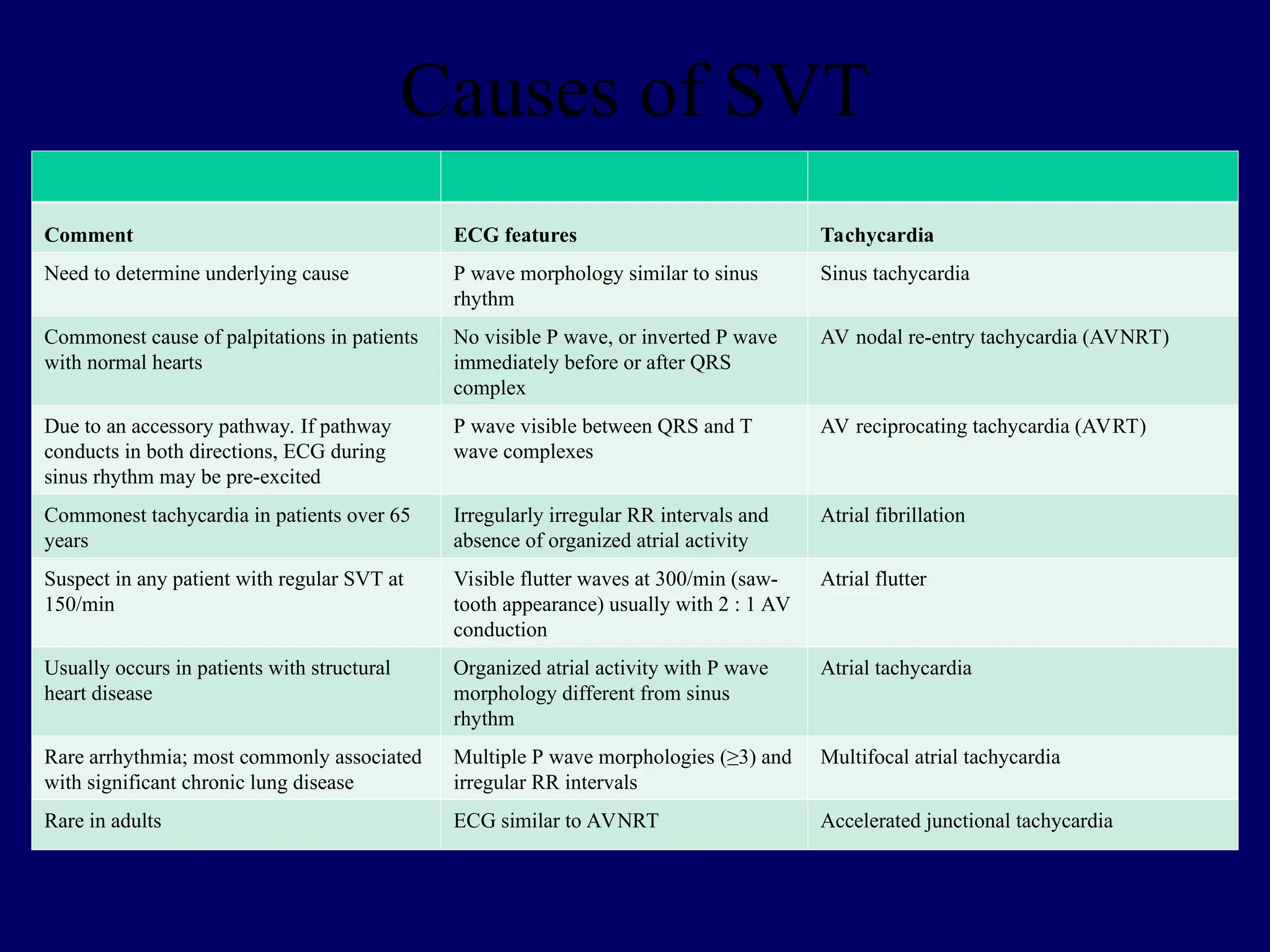 A presentation on Cardiac-Arrhythmias final.ppt