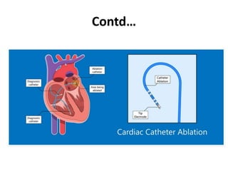 Cardiac Ablation Catheter used in cardiac systems | PPT