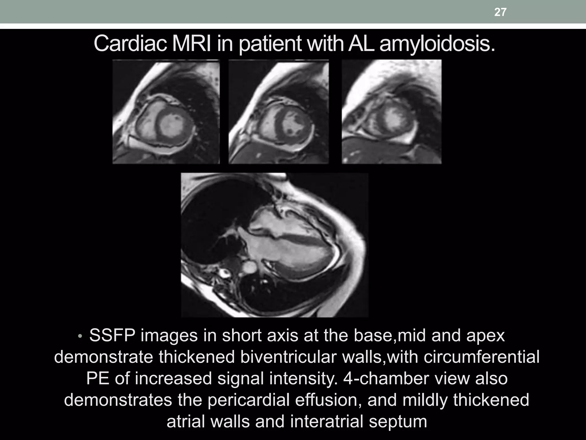 Cardiac amyloidosis | PPTX