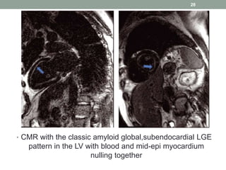 Cardiac amyloidosis | PPTX