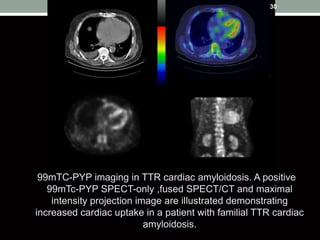 Cardiac amyloidosis | PPTX