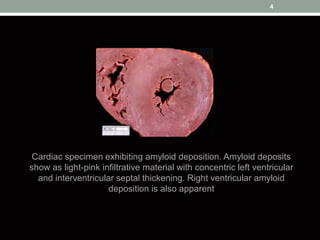 Cardiac amyloidosis | PPTX