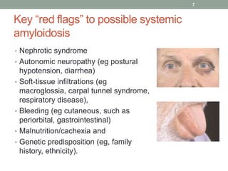 Cardiac amyloidosis | PPTX