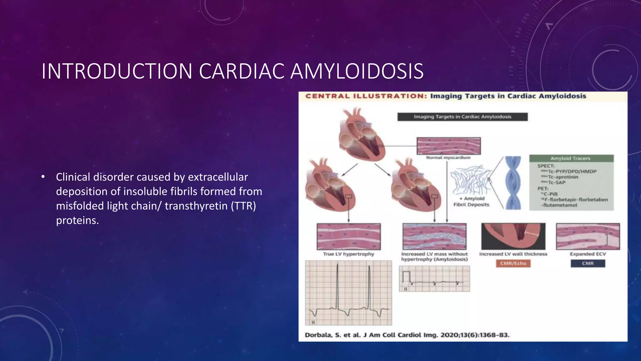 CARDIAC AMYLOIDOSIS | PPTX