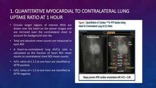 CARDIAC AMYLOIDOSIS | PPTX