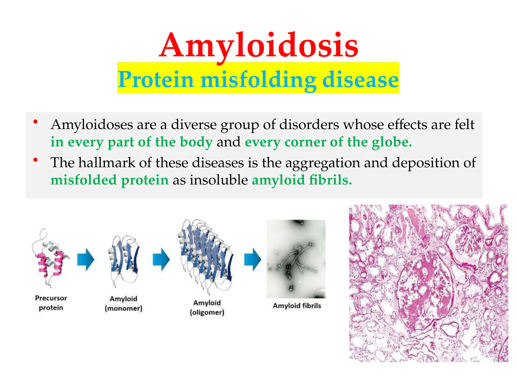 Cardiac amyloid heart disease , state of the art power point lecture ...