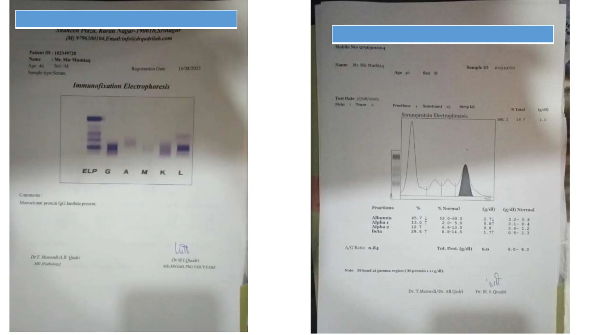 CARDIAC AMYLOIDOSIS a brief review – sameer.pptx