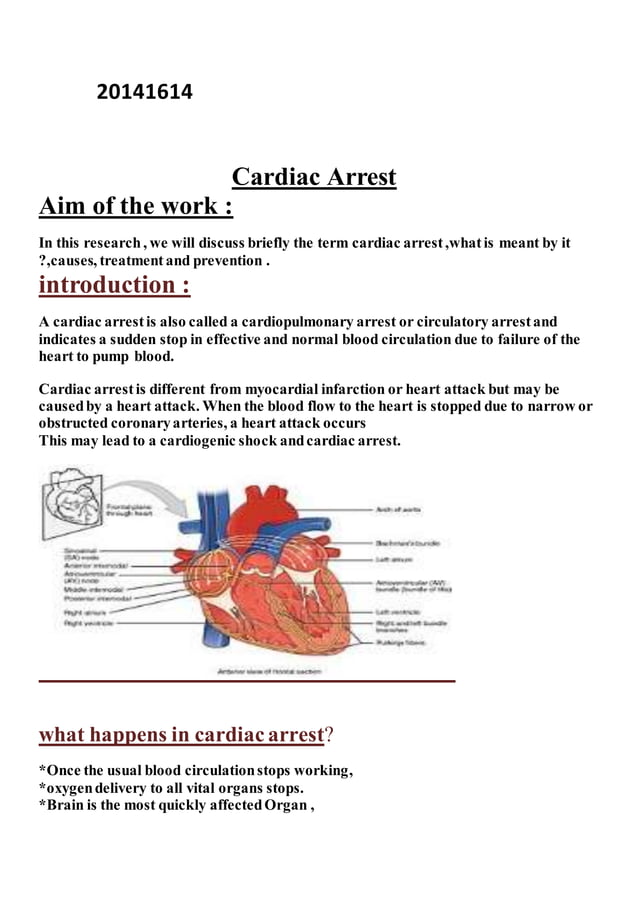 Cardiac arrest | PDF