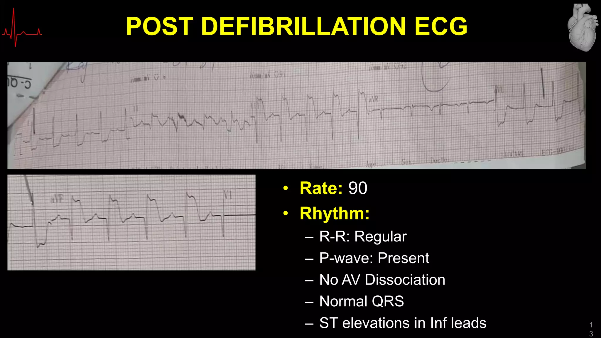 Cardiac arrest an overview of defibrillation vs cardioversion | PPTX ...