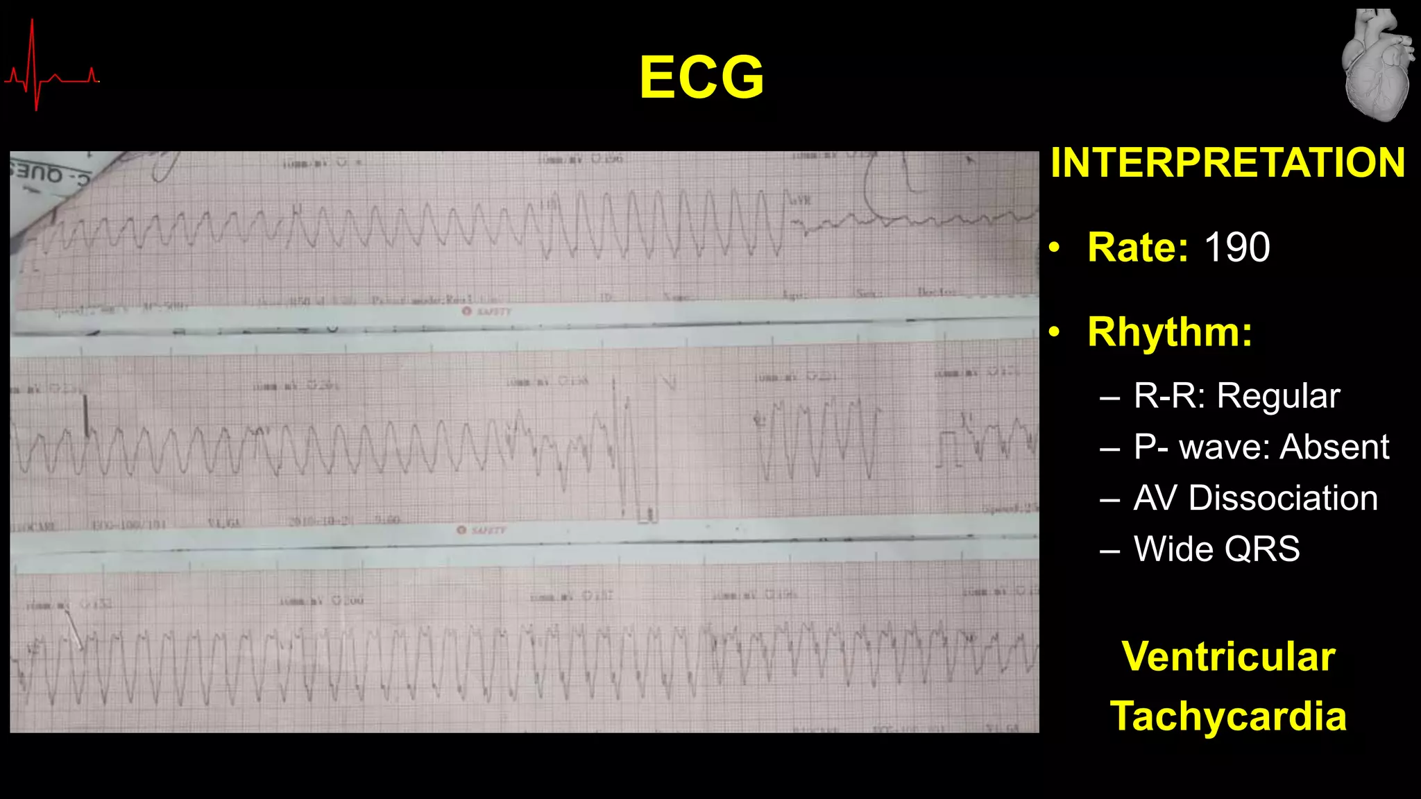 Cardiac arrest an overview of defibrillation vs cardioversion | PPT