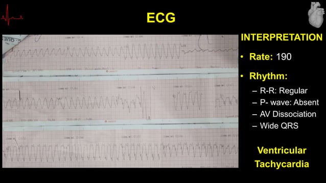 Cardiac arrest an overview of defibrillation vs cardioversion | PPTX ...