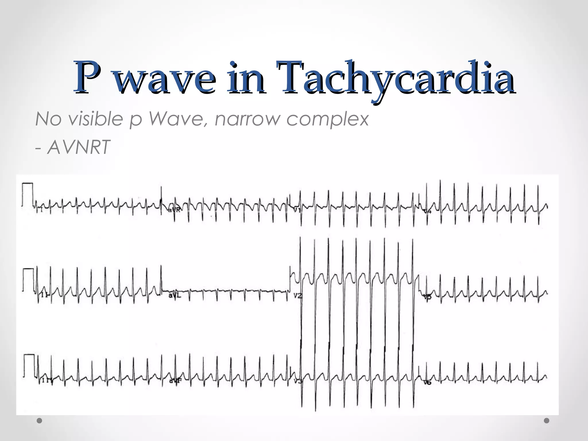 SVT in pediatrics | PPT