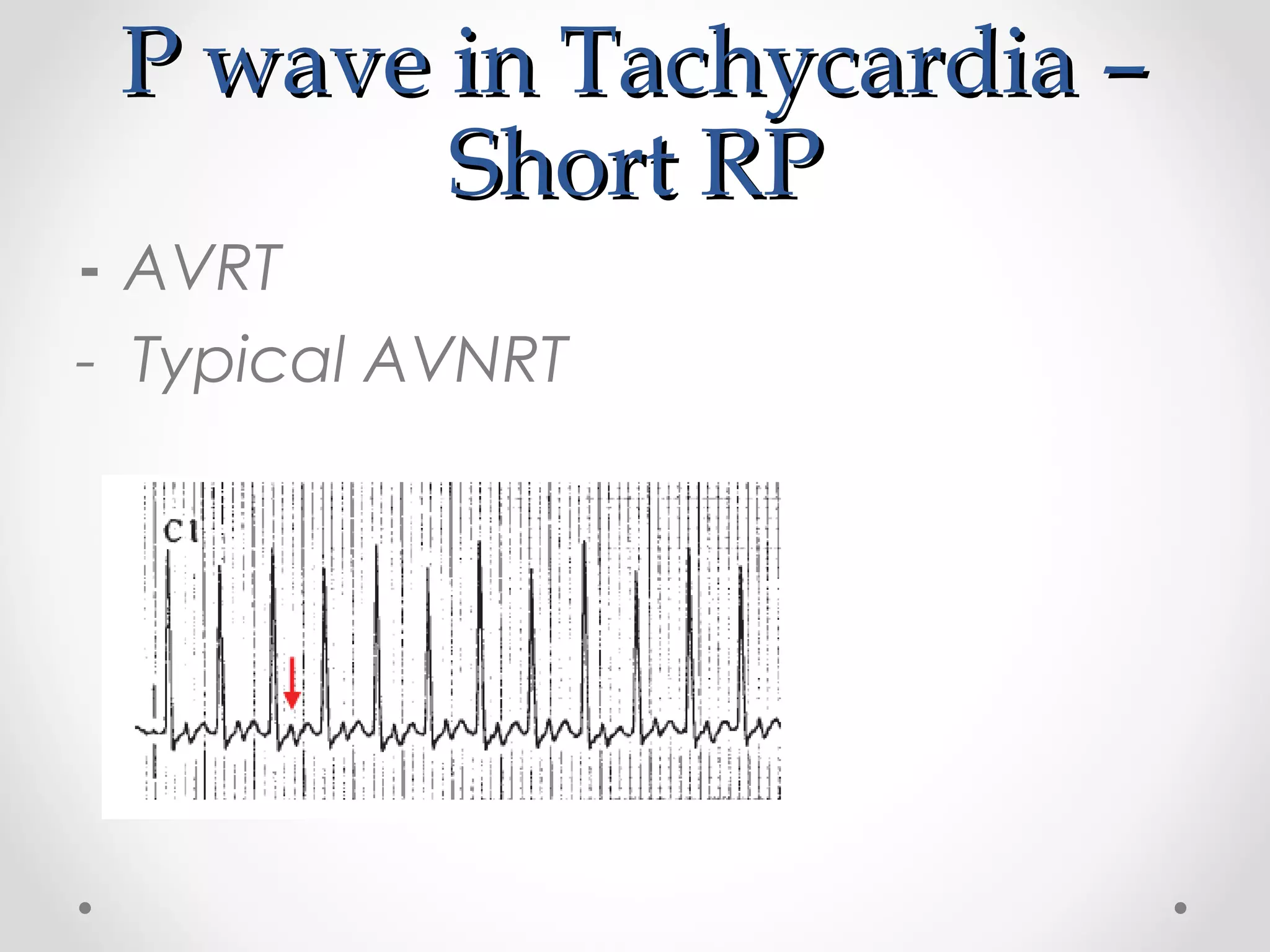 SVT in pediatrics | PPT