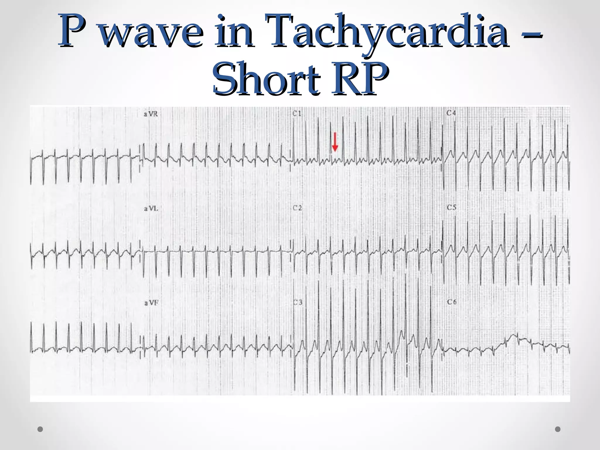 SVT in pediatrics | PPT