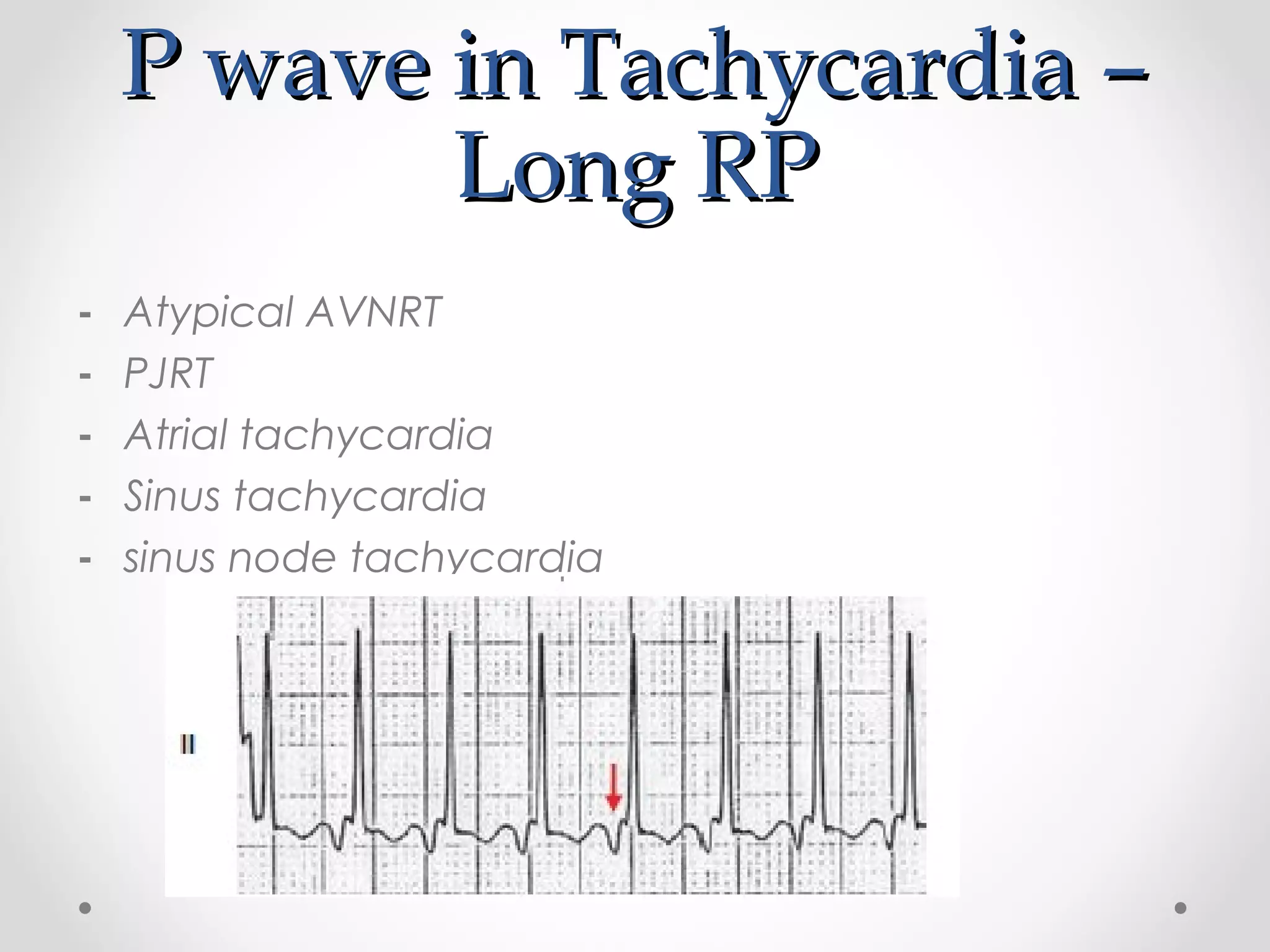 SVT in pediatrics | PPT