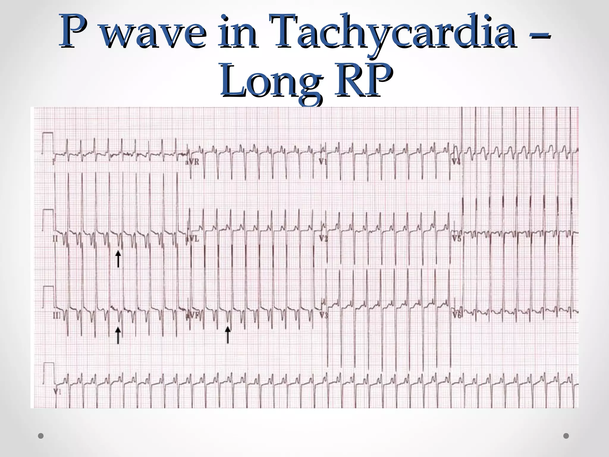 SVT in pediatrics | PPT