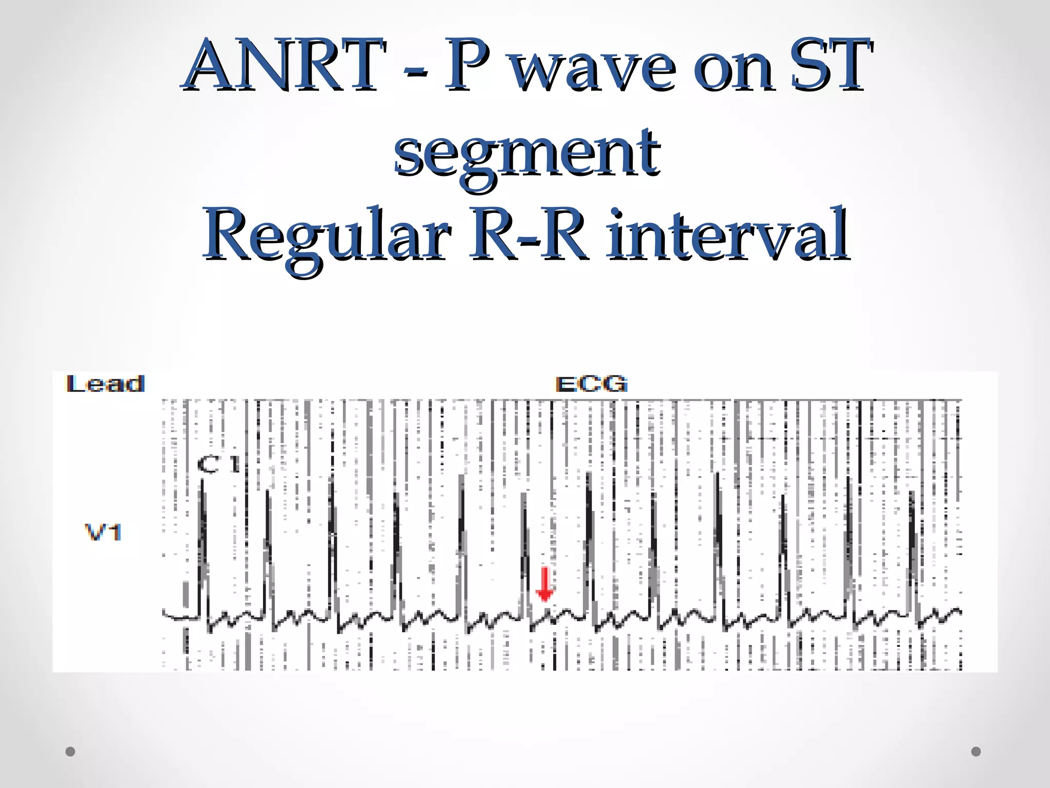 SVT in pediatrics | PPT