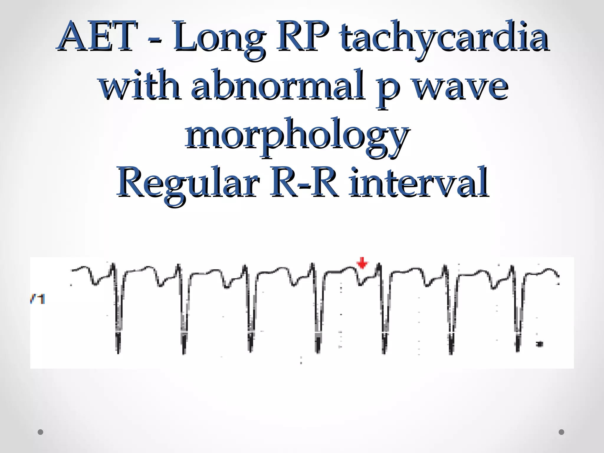 SVT in pediatrics | PPT