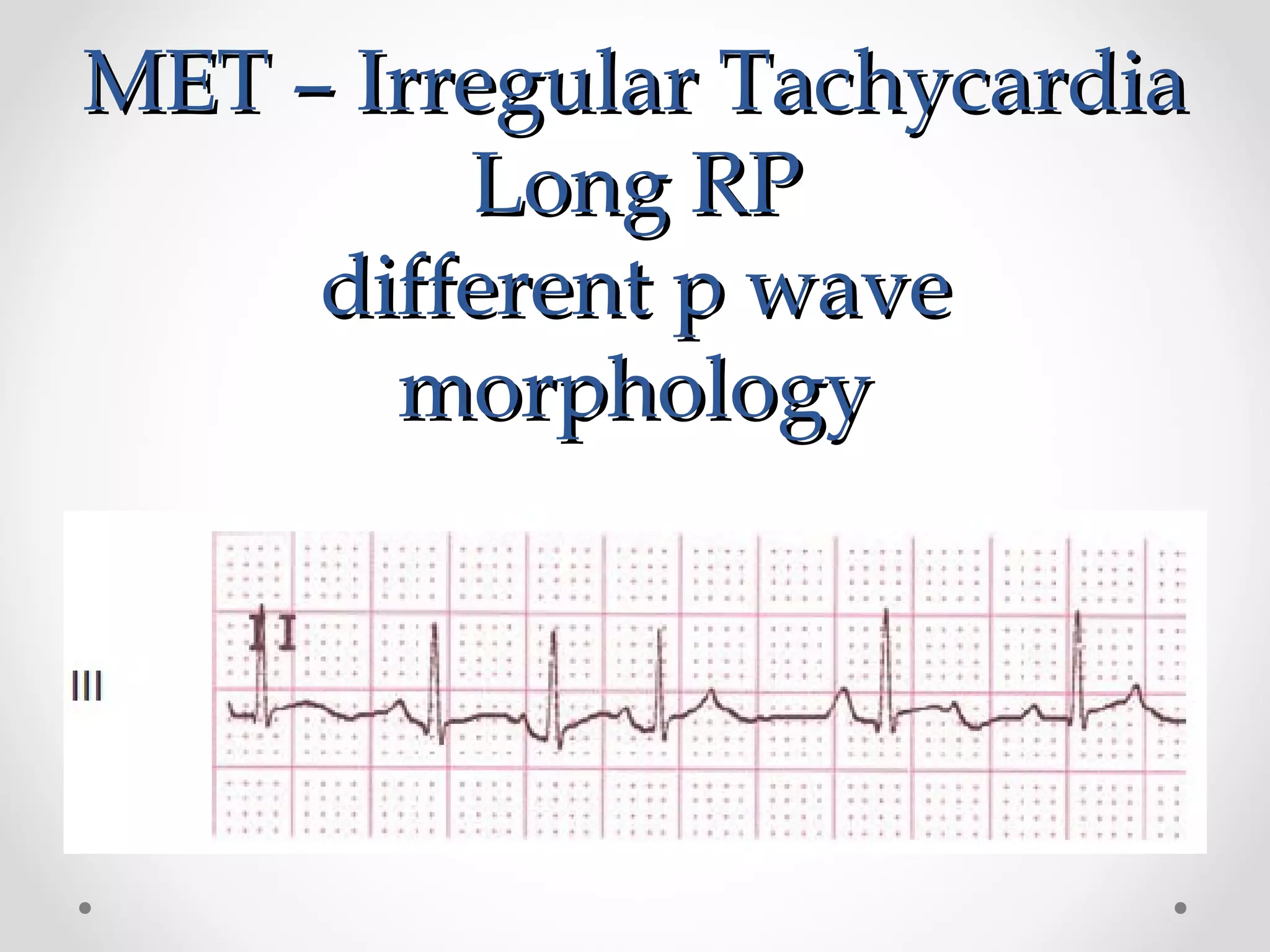 SVT in pediatrics | PPT