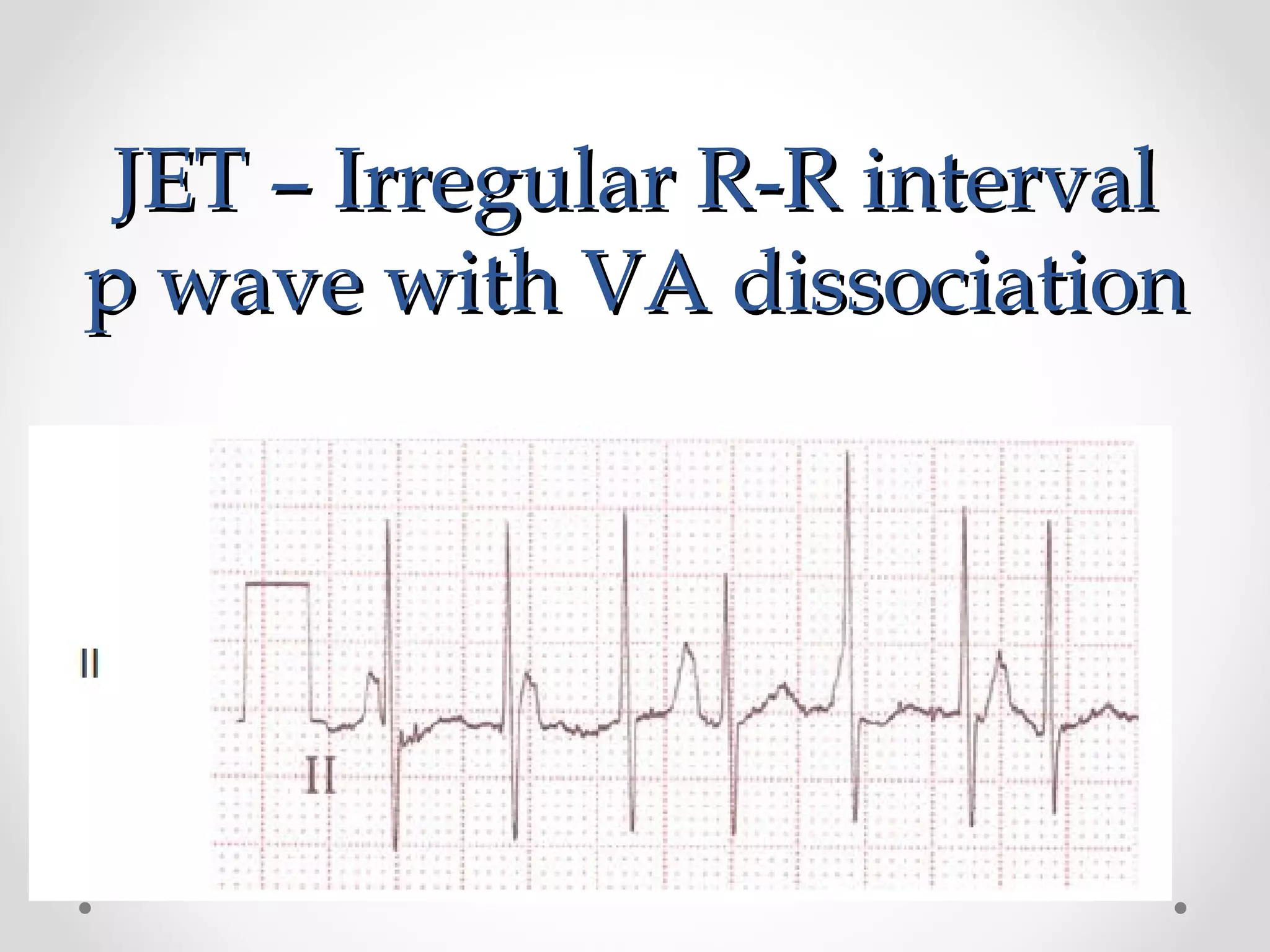 SVT in pediatrics | PPT | Heart and Cardiovascular Diseases | Diseases ...