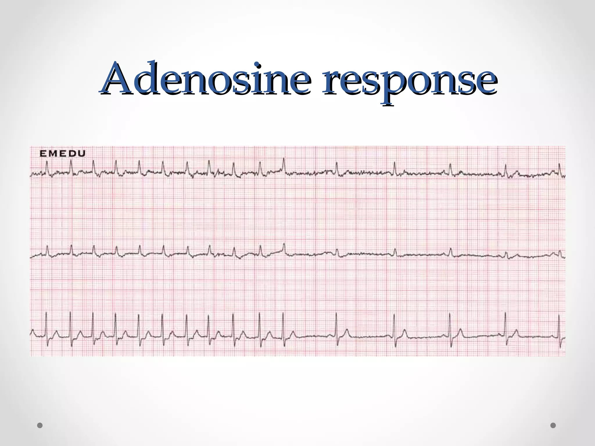 SVT in pediatrics | PPT
